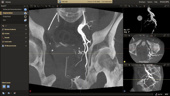 Prostate Artery Embolization Pae Philips